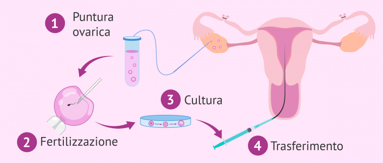 FIVET con legatura delle tube