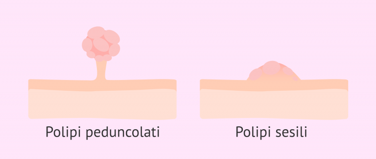 Cos'è un polipo endometriale o uterino? - Sintomi e trattamento